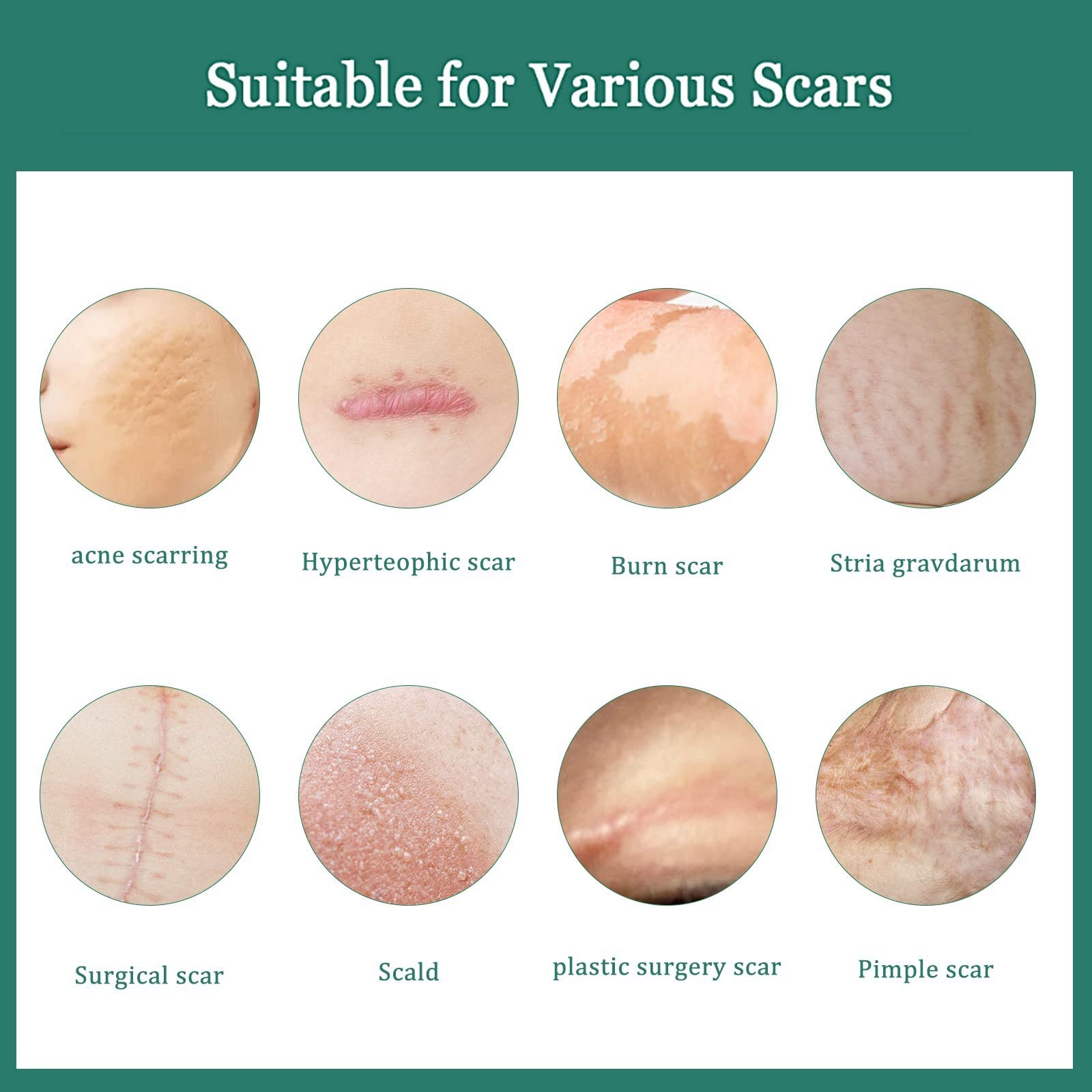 for Cooking Scar Removal Scar For Old Stretch Mark Removal For Men Women Stretch Marks And Burns Face Skin Volcanic Stone Face Roller