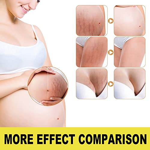 Fix A Plate Stretch Mark For Pregnancy Scar Slack Line Abdomen Stretch Marks Stretch Marks From Pregnancy Scar Slack Line Abdomen Stretch Marks Postpartum Skin Roller
