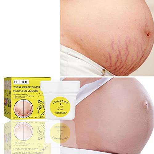 Fix A Plate Stretch Mark For Pregnancy Scar Slack Line Abdomen Stretch Marks Stretch Marks From Pregnancy Scar Slack Line Abdomen Stretch Marks Postpartum Skin Roller