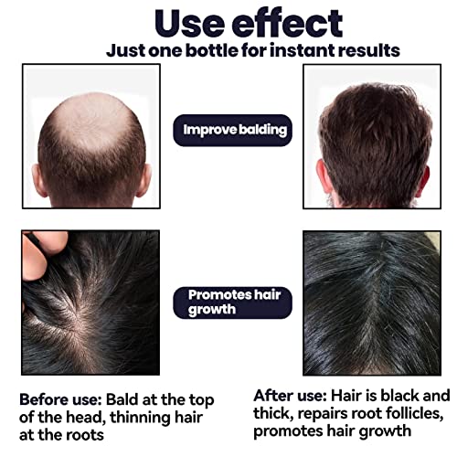 Hair Regrowth Serum, Reduce Loss 30ml Improve Scalp Circulation Hair Strengthening Serum for Home Use