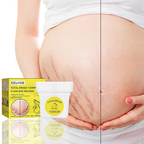 Fix A Plate Stretch Mark For Pregnancy Scar Slack Line Abdomen Stretch Marks Stretch Marks From Pregnancy Scar Slack Line Abdomen Stretch Marks Postpartum Skin Roller