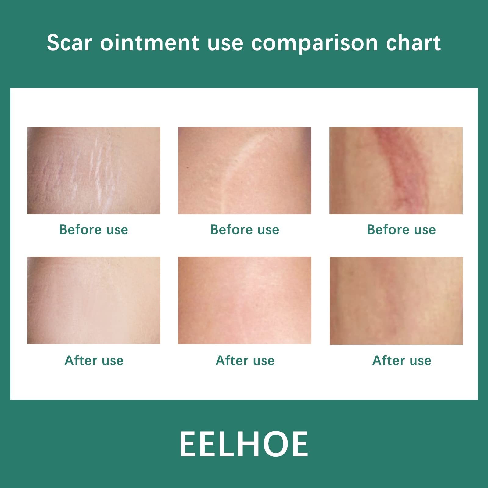 for Cooking Scar Removal Scar For Old Stretch Mark Removal For Men Women Stretch Marks And Burns Face Skin Volcanic Stone Face Roller