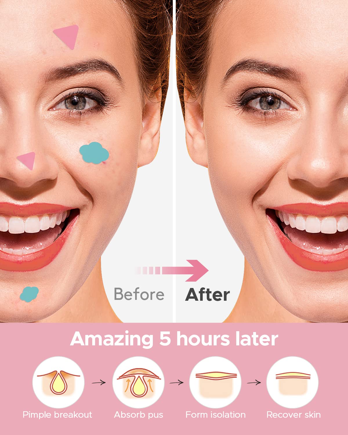 LitBear Acne Patch Pimple Patch, Cloud & Triangle Shaped Acne Absorbing Cover Patch, Hydrocolloid Acne Patches For Face Zit Patch Acne Dots, Tea Tree Oil + Centella, 112 Patches, 14mm & 10mm