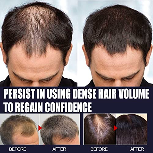 Hair Regrowth Serum, Reduce Loss 30ml Improve Scalp Circulation Hair Strengthening Serum for Home Use