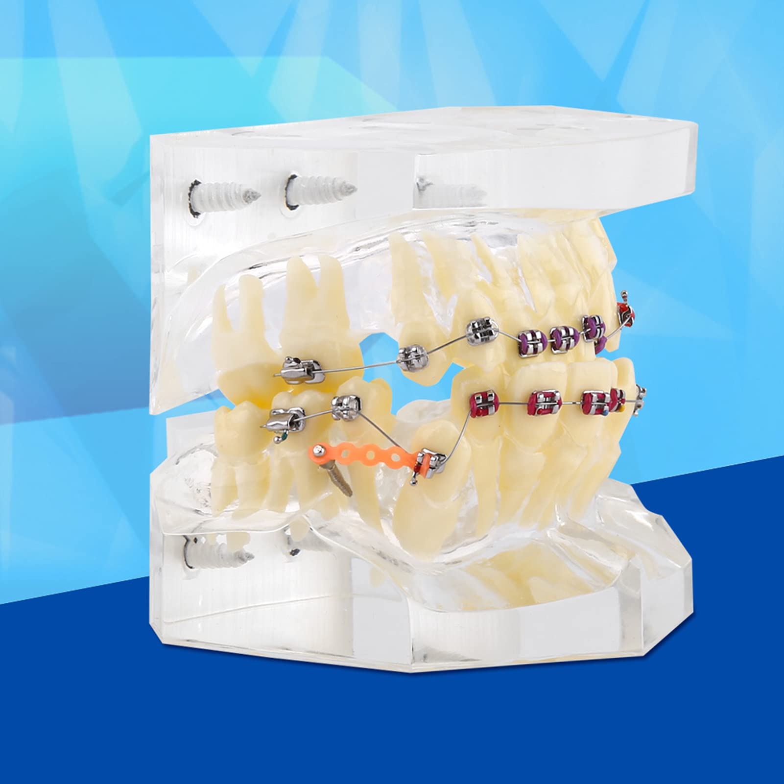 Orthodontic Teeth Model with Metal Brackets and Wires for Adult and Children Malocclusion Study and Braces Demonstration