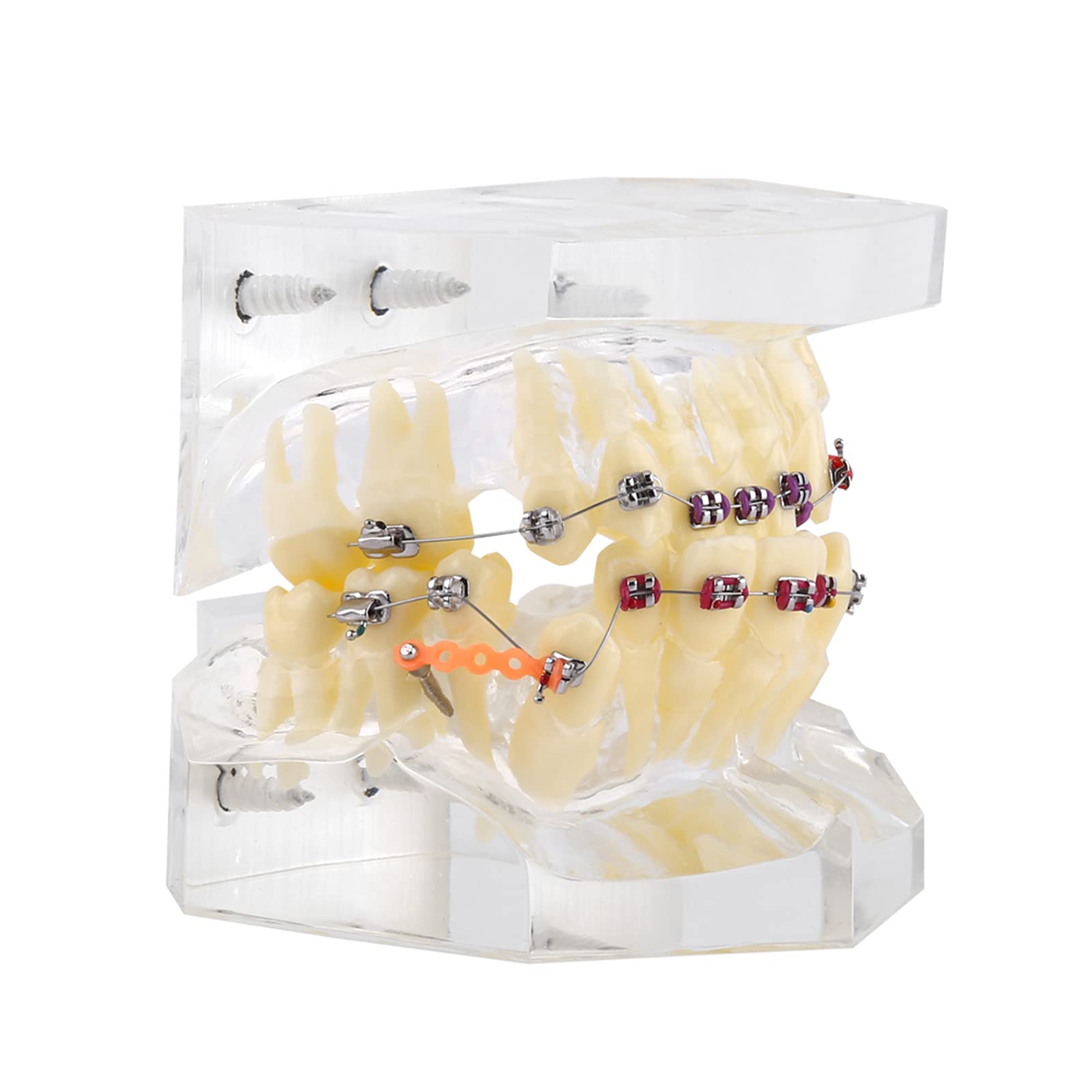 Orthodontic Teeth Model with Metal Brackets and Wires for Adult and Children Malocclusion Study and Braces Demonstration