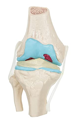 Spancare 4 Stage Osteoarthritis Anatomical Knee Model, Model On Base, with Detailed Study