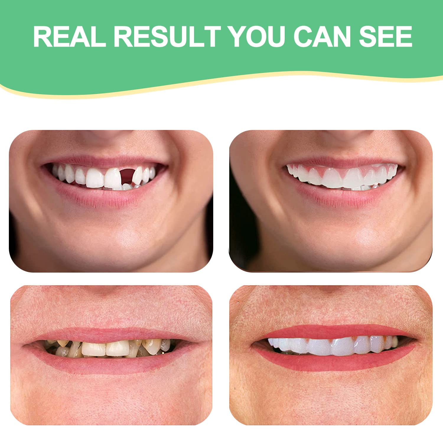 Fake Teeth - Veneers Teeth for Women and Men - 2PCs Smile Kit - Snap on Veneers False Teeth, Dentures for Women, Swift Smile Snap on Teeth Snap-on Smile-A