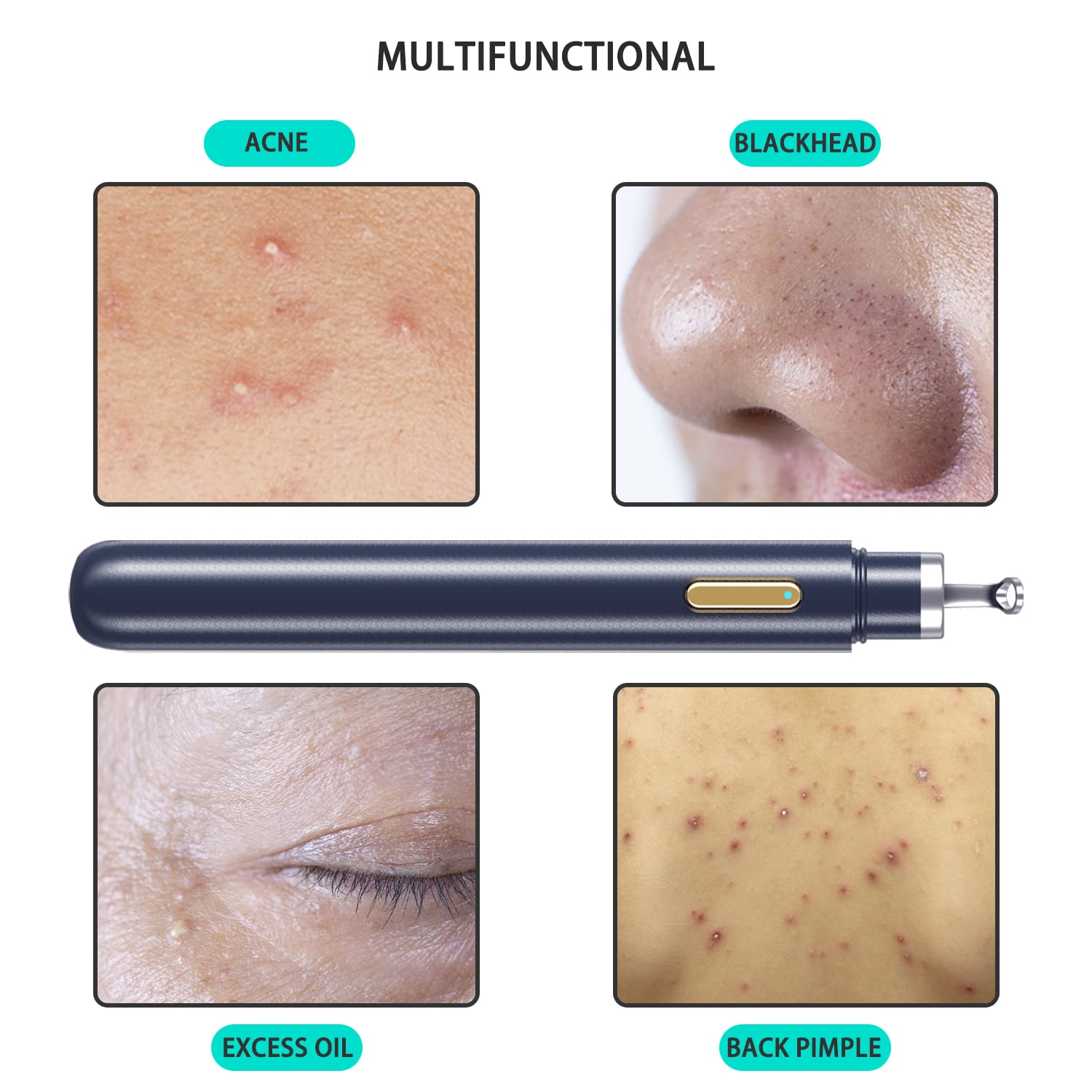 Men’s Visible Blackhead Extractor[2022 New], Advanced Pimple Popper with 20X Camera Acne Comedone Whitehead Zit Remover Tool, womfenn Facial Pore Extraction Tools Kit