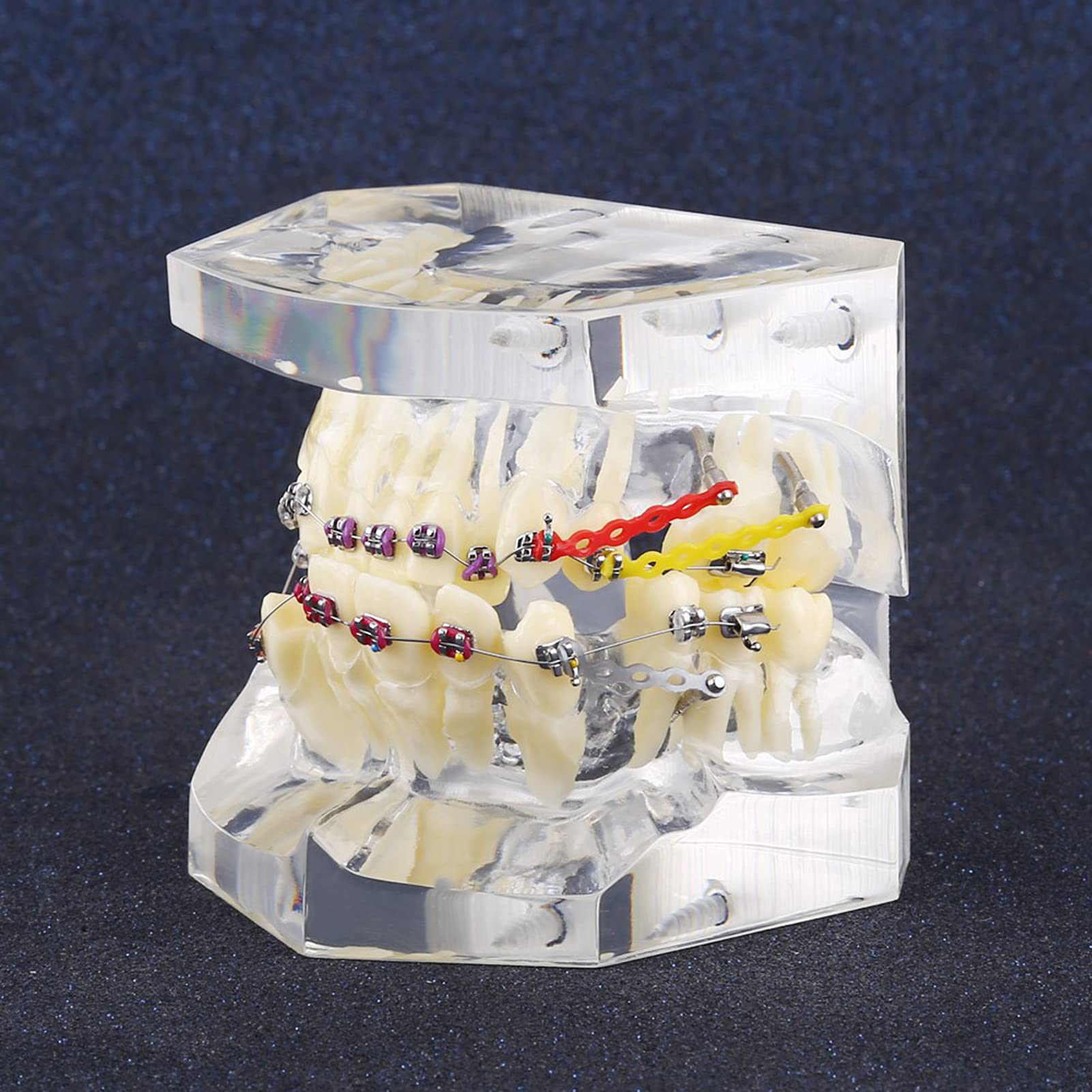 Orthodontic Teeth Model with Metal Brackets and Wires for Adult and Children Malocclusion Study and Braces Demonstration