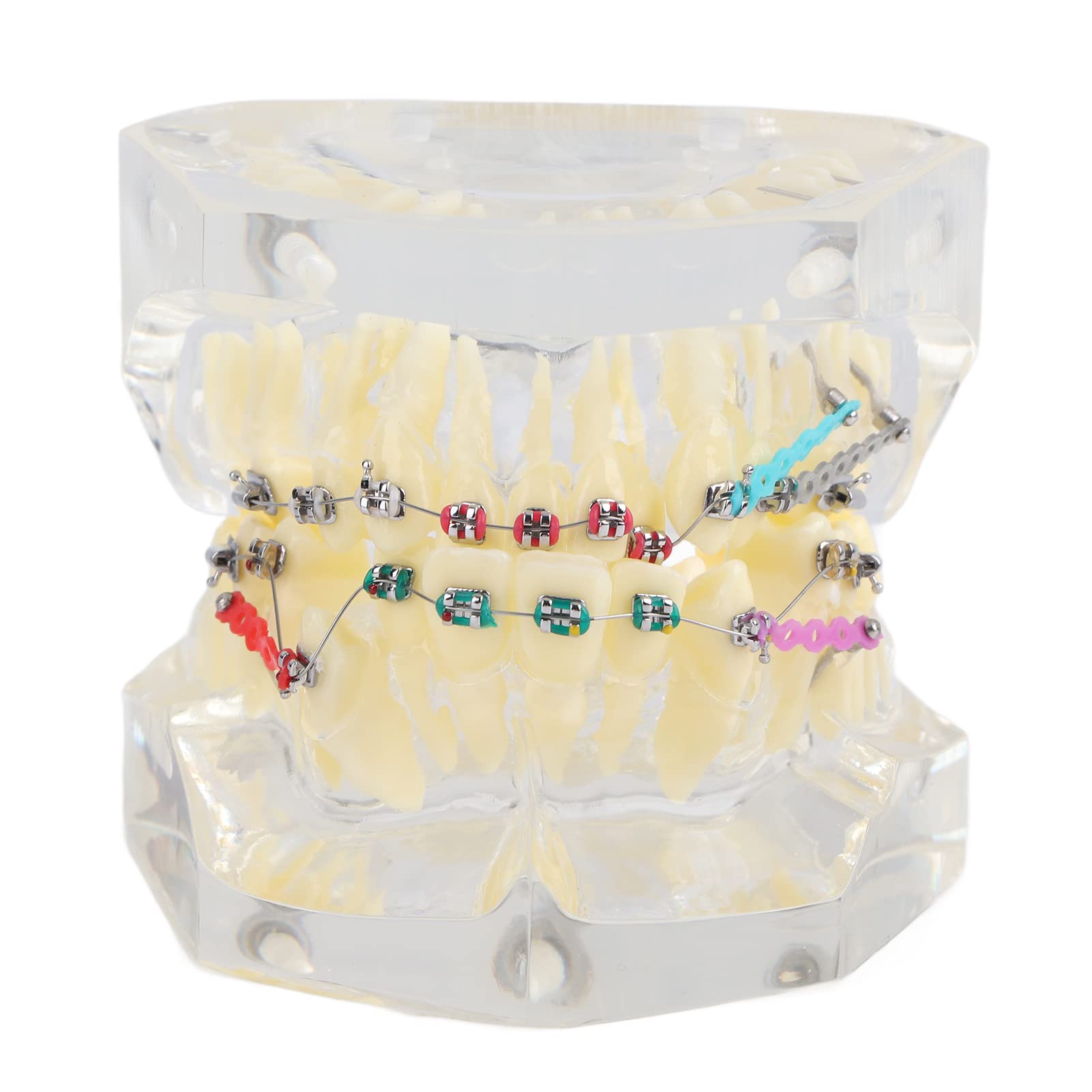 Orthodontic Teeth Model with Metal Brackets and Wires for Adult and Children Malocclusion Study and Braces Demonstration