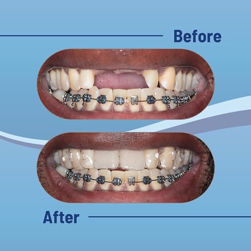 OrVance Aligner Pontics | Temporary Tooth Replacement for Aligner Tray and Retainer - Fill Space of Missing Teeth with Fake Teeth (16 Count)