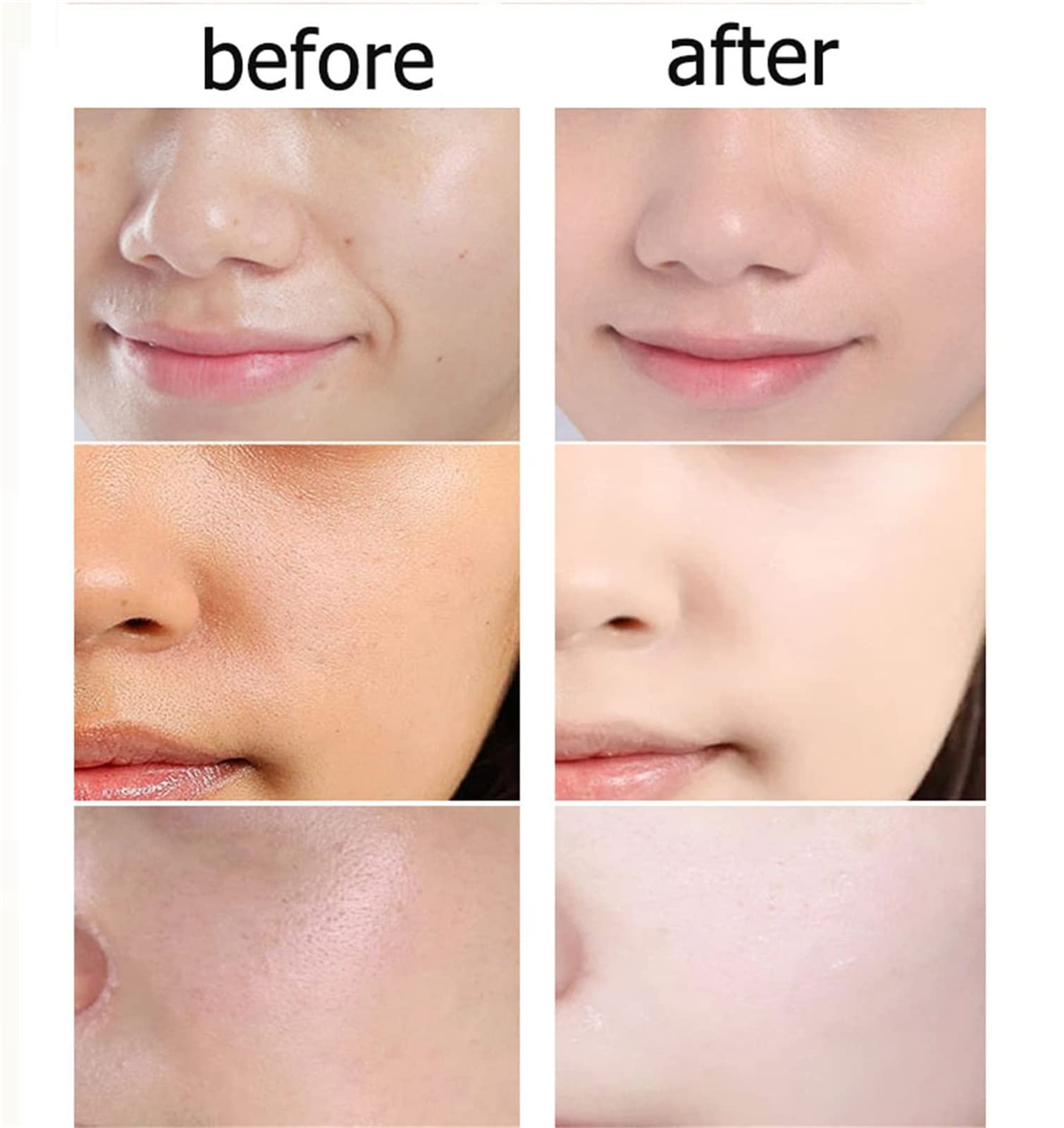 Hilos Tensores Para El Rostro, Hilos de Colageno Absorbibles para la Cara, Acido Hialuronico Puro Para Rostro, Proform Korean Soluble Protein Thread, Face Serum for Lift