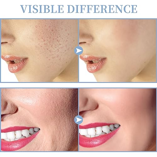 High Frequency Facial Machine - TUMAKOU Portable Handheld High Frequency Facial Skin Wand Machine with 4 Different Tubes