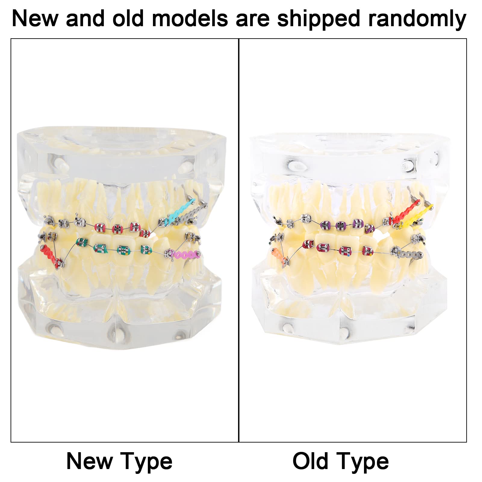Orthodontic Teeth Model with Metal Brackets and Wires for Adult and Children Malocclusion Study and Braces Demonstration