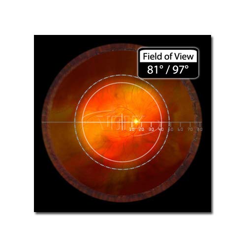 Volk Optical 78D Indirect Ophthalmic Slit Lamp Lens – Blue