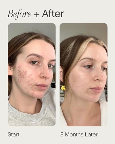 Topicals Faded Skin Serum for Dark Spots and Discoloration - Hyperpigmentation Safe - Tranexamic Acid and Niacinamide for Post-Blemish Marks, Scars and Spots (1.7 Fl Oz)