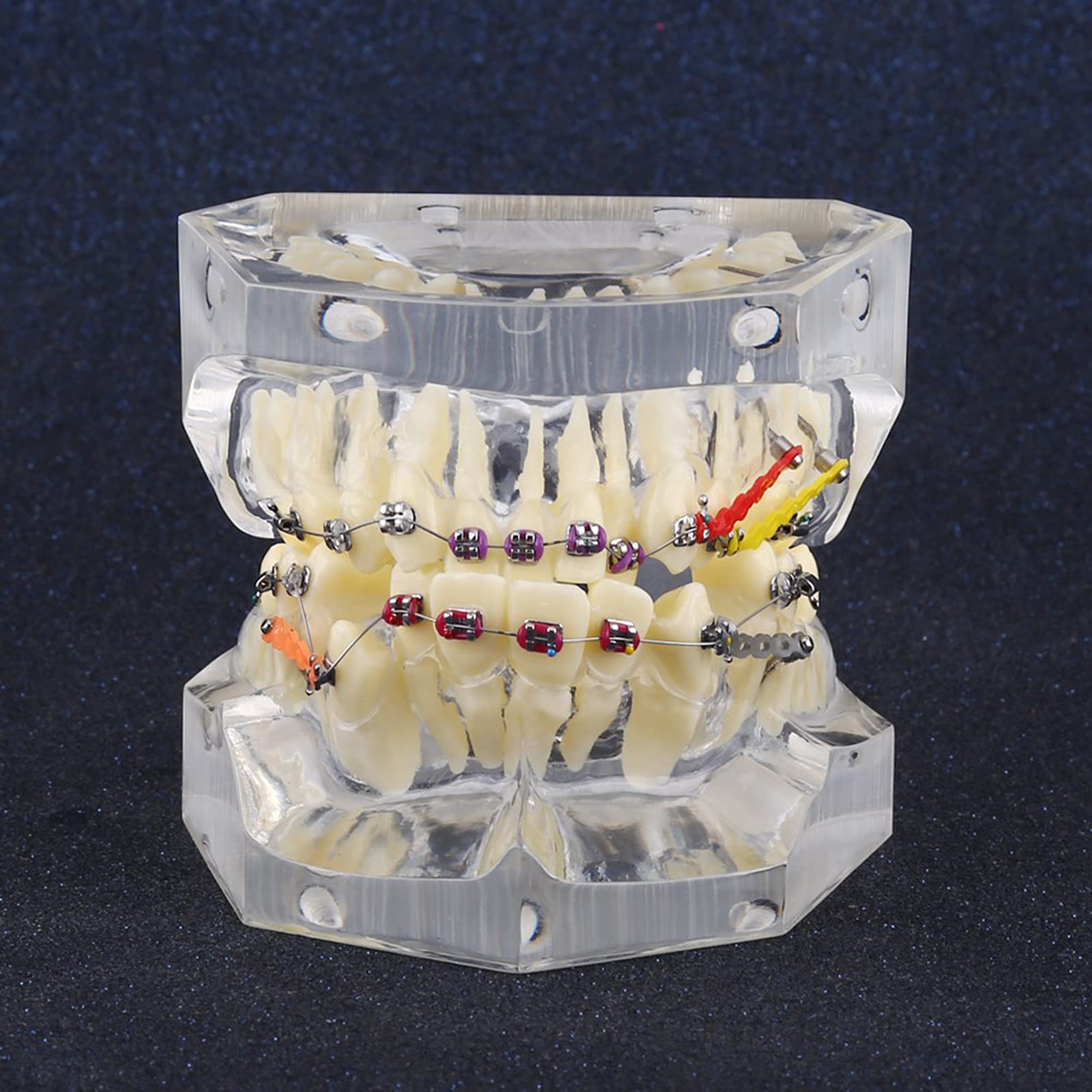 Orthodontic Teeth Model with Metal Brackets and Wires for Adult and Children Malocclusion Study and Braces Demonstration