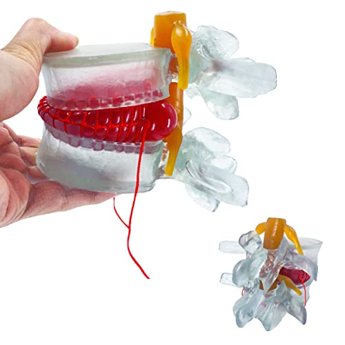Veipho Human Anatomical Lumbar Disc Herniation Model, Transparency Lumbar Disc Herniation Model, Lumbar Disc Model for Teaching and Demonstrating
