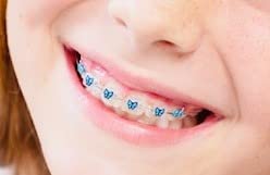 Snapcaps Braces Bumper Cover, Orthodontic Bracket Wax Substitute, Alternative Snap-on Braces Guard Braces Accessories 10 pack (Butterfly)