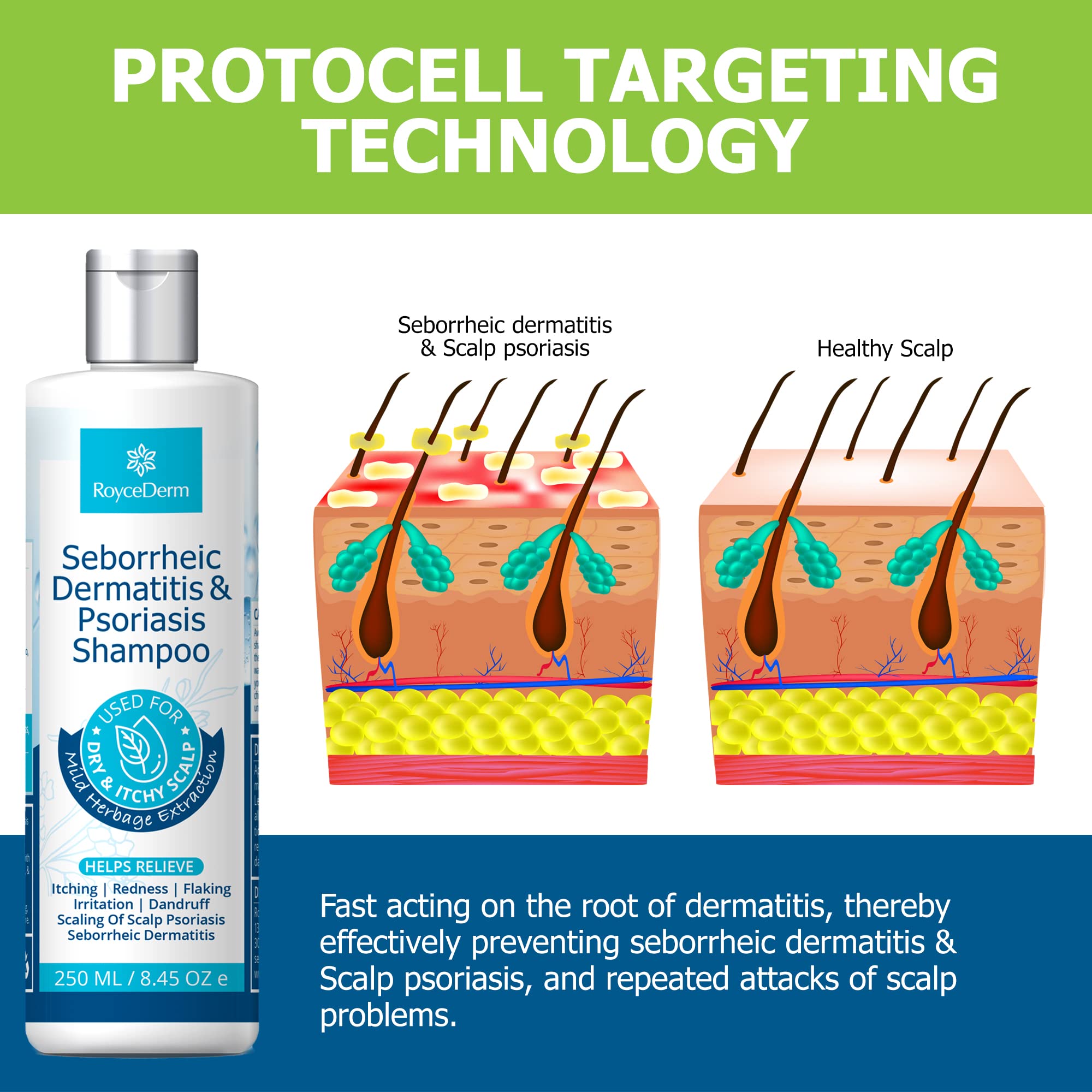 Roycederm Psoriasis Shampoo, Seborrheic Dermatitis Shampoo, Folliculitis Shampoo, Dandruff Shampoo, Scalp Psoriasis & Seborrheic Dermatitis Treatment, Dry Itchy Scalp Treatment