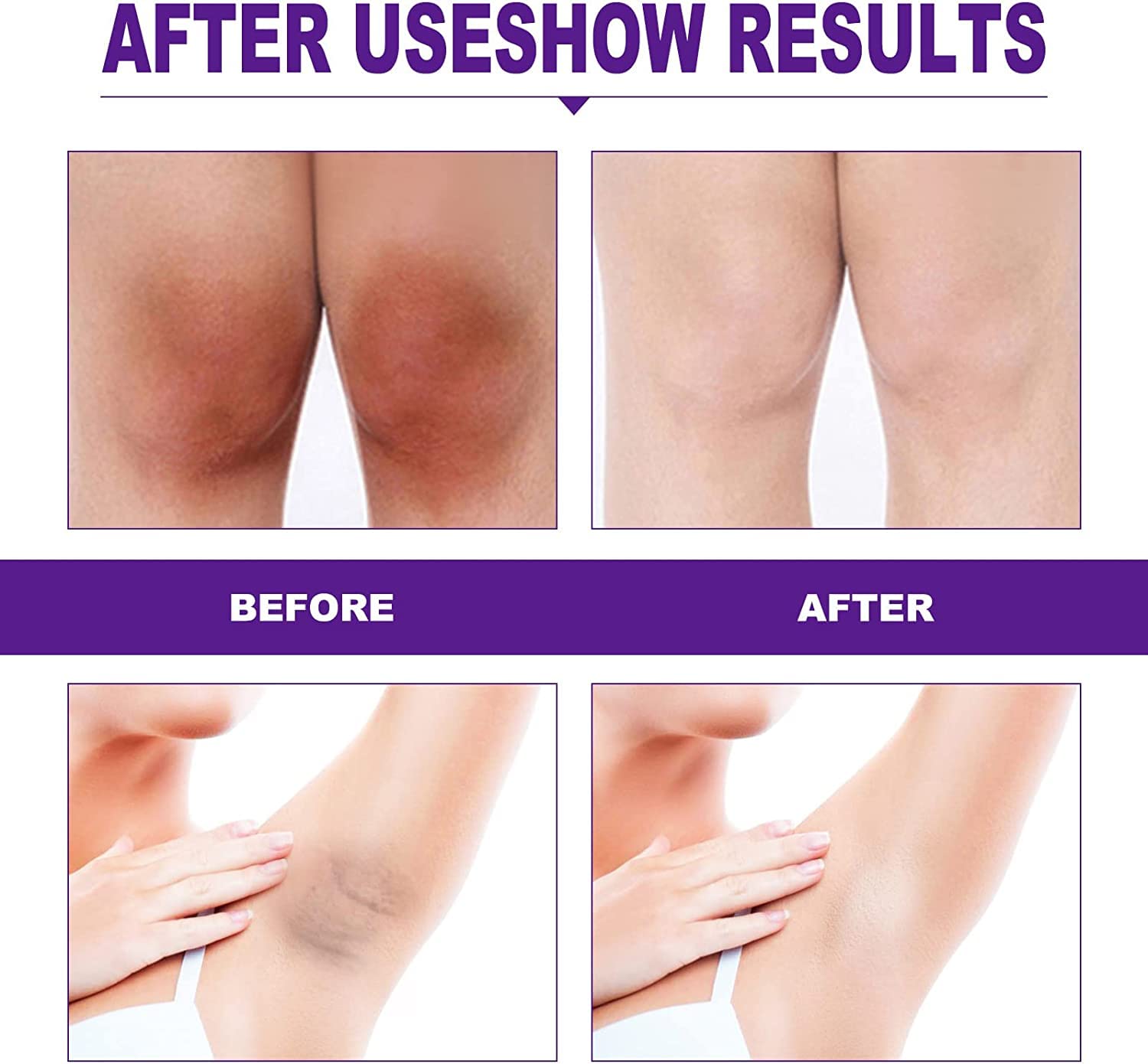 Intimate Bleaching Cream for Women,Crema blanqueadora íntima para mujeres,Underarm Bleaching Serum Whiten Butt Knee Brighten Inner Thigh Intimate Parts Dark Remove Melanin (1pcs,B-20ML)