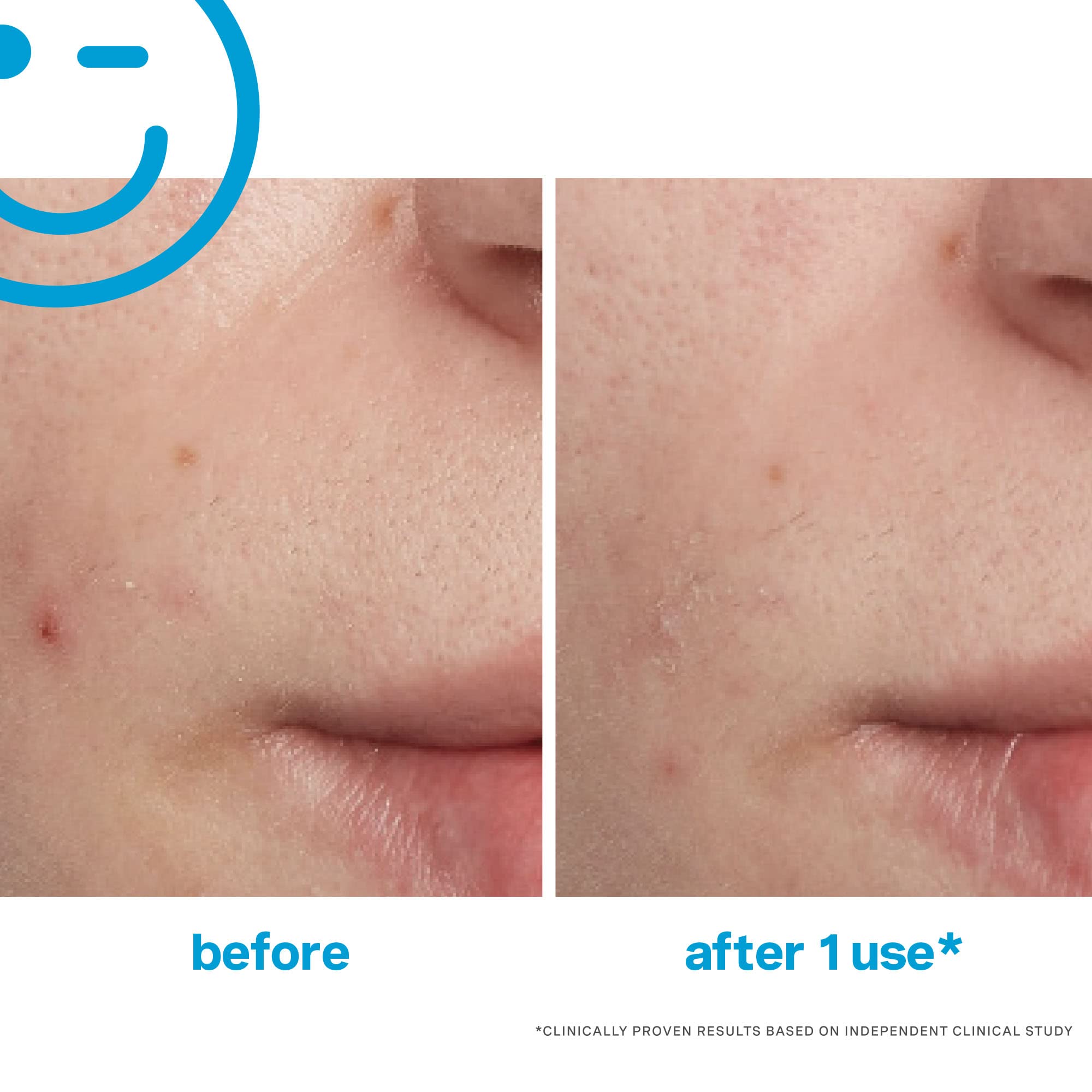 Kate Somerville EradiKate Acne Treatment - Clinically Formulated 10% Sulfur and BHA Spot Treatment – Clears Pimples, Cleans Pores and Prevents Breakouts, 1 Fl Oz