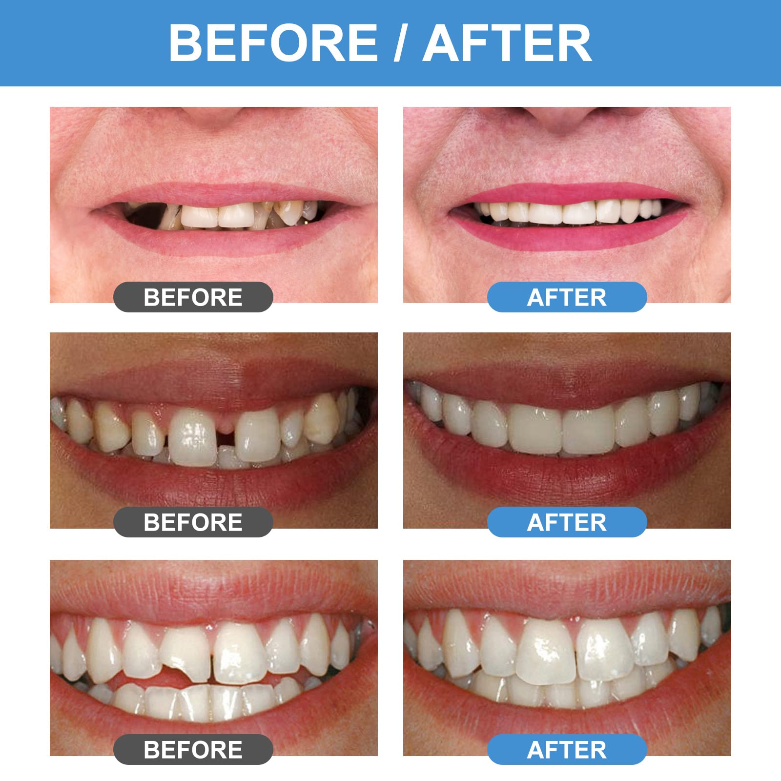 Tooth Repair Kit, Fake Teeth for Temporary Fixing The Missing and Broken Tooth Replacements