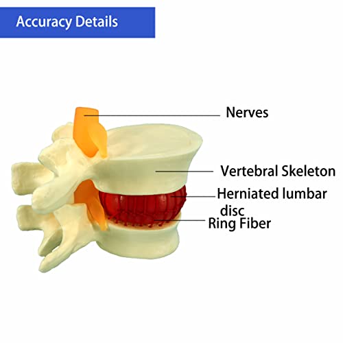 Veipho Human Anatomical Lumbar Disc Herniation Model, 1.5 Times Life Size Lumbar Disc Herniation Model, Human Lumbar Disc Herniation Model for Teaching, Learning, Demonstrating