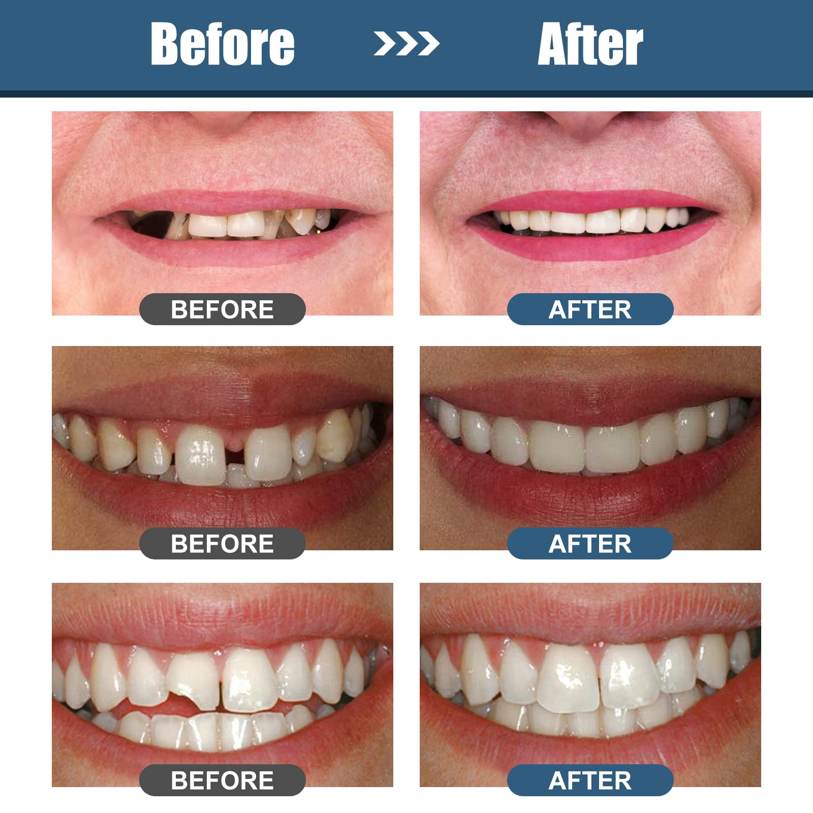 Tooth-Repair-Kit Fixing-The-Missing-and-Broken-Tooth-Replacements Temporary-Teeth-Filling-Repair-Kit-with-Mouth-Mirror Tartar-Scraper Dental-Probe Gum-Cleaner Regain-Confidence-Smile