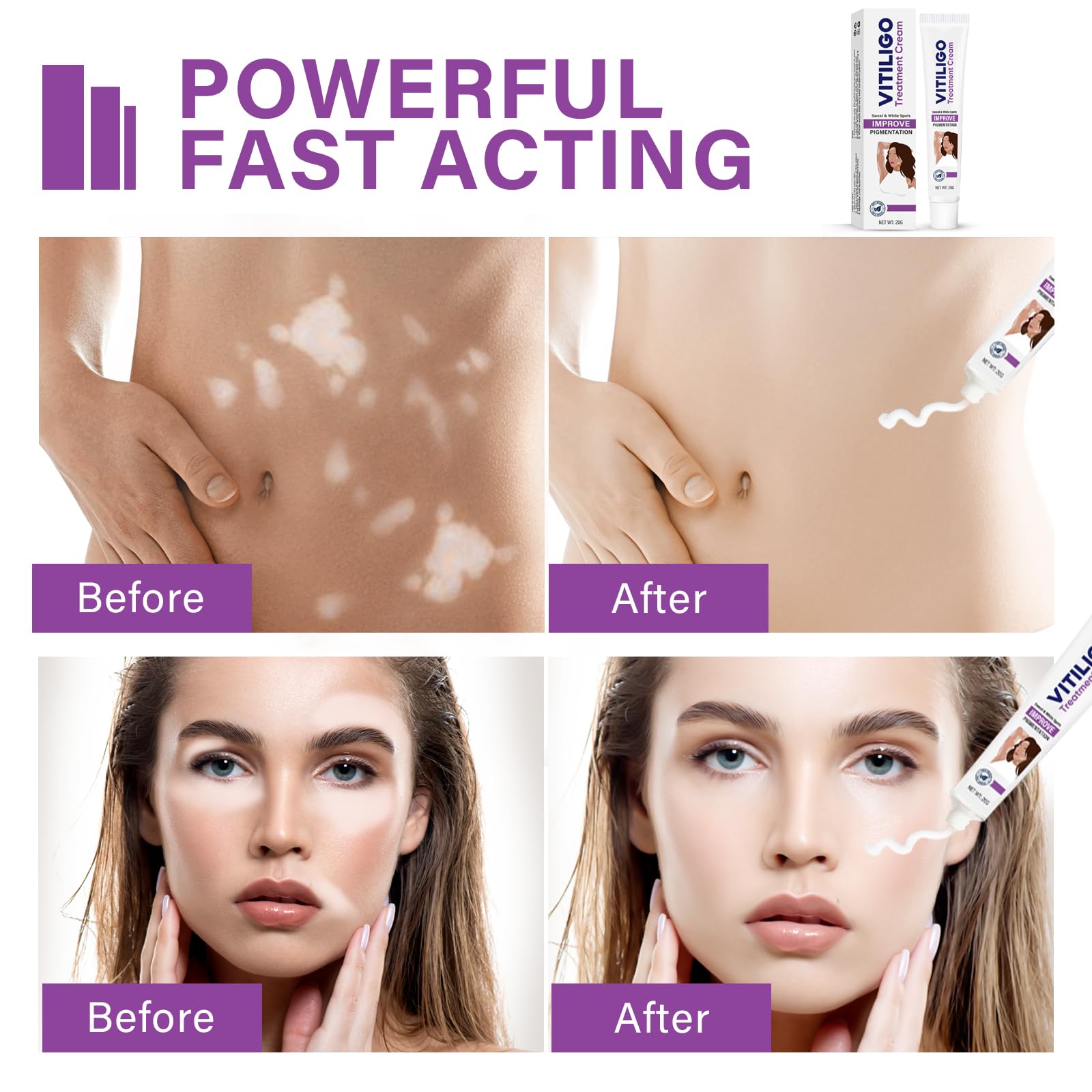 Xshows Vitiligo Cream, Vitiligo Treatment for Reduce White Spots and Improve Skin Pigmentation (Packaging May Vary)
