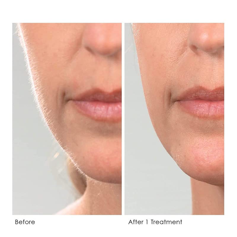Michael Todd Beauty - Sonicsmooth Replacement Kit for At-Home Dermaplaning - 7 Replacement Safety Edges Only