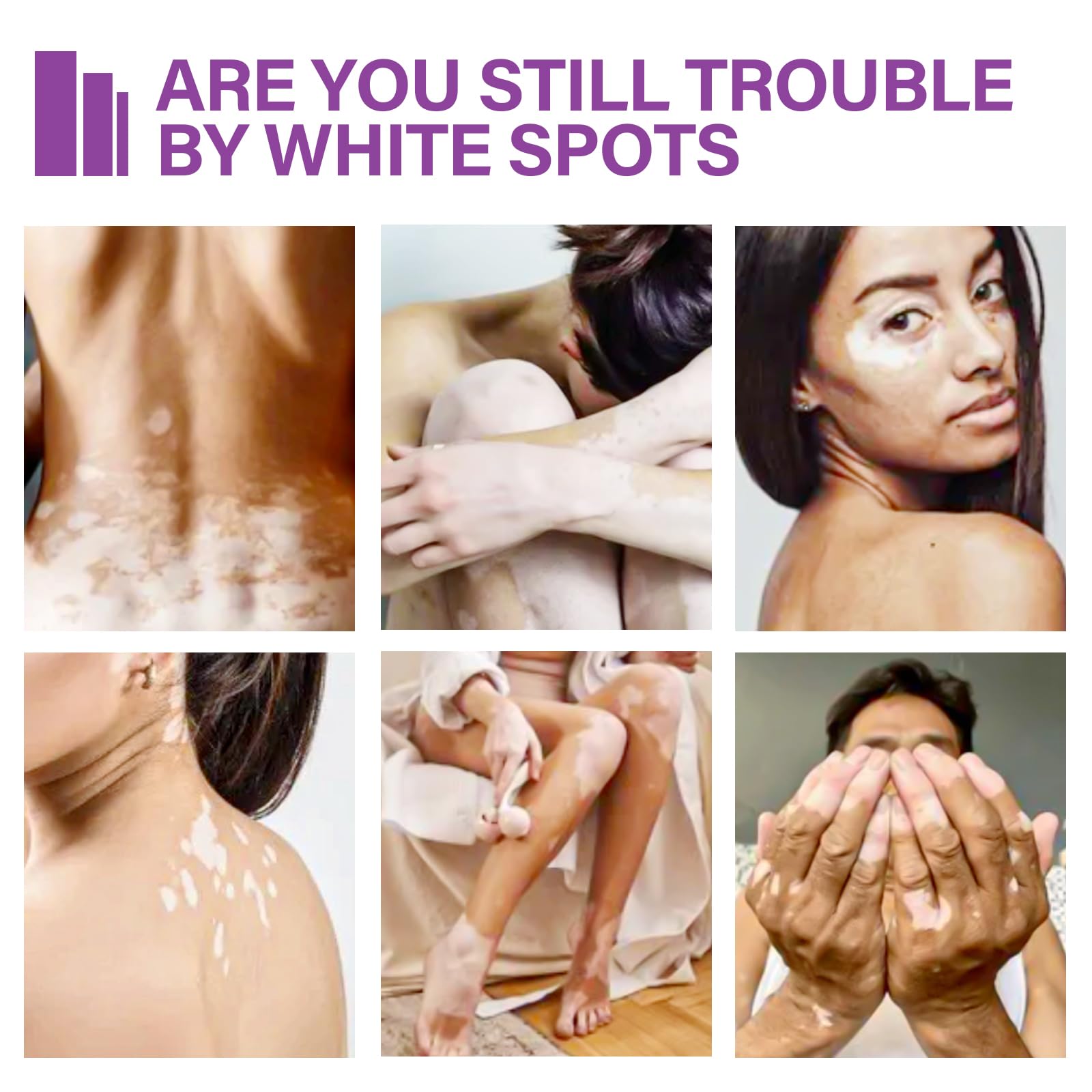 Xshows Vitiligo Cream, Vitiligo Treatment for Reduce White Spots and Improve Skin Pigmentation (Packaging May Vary)