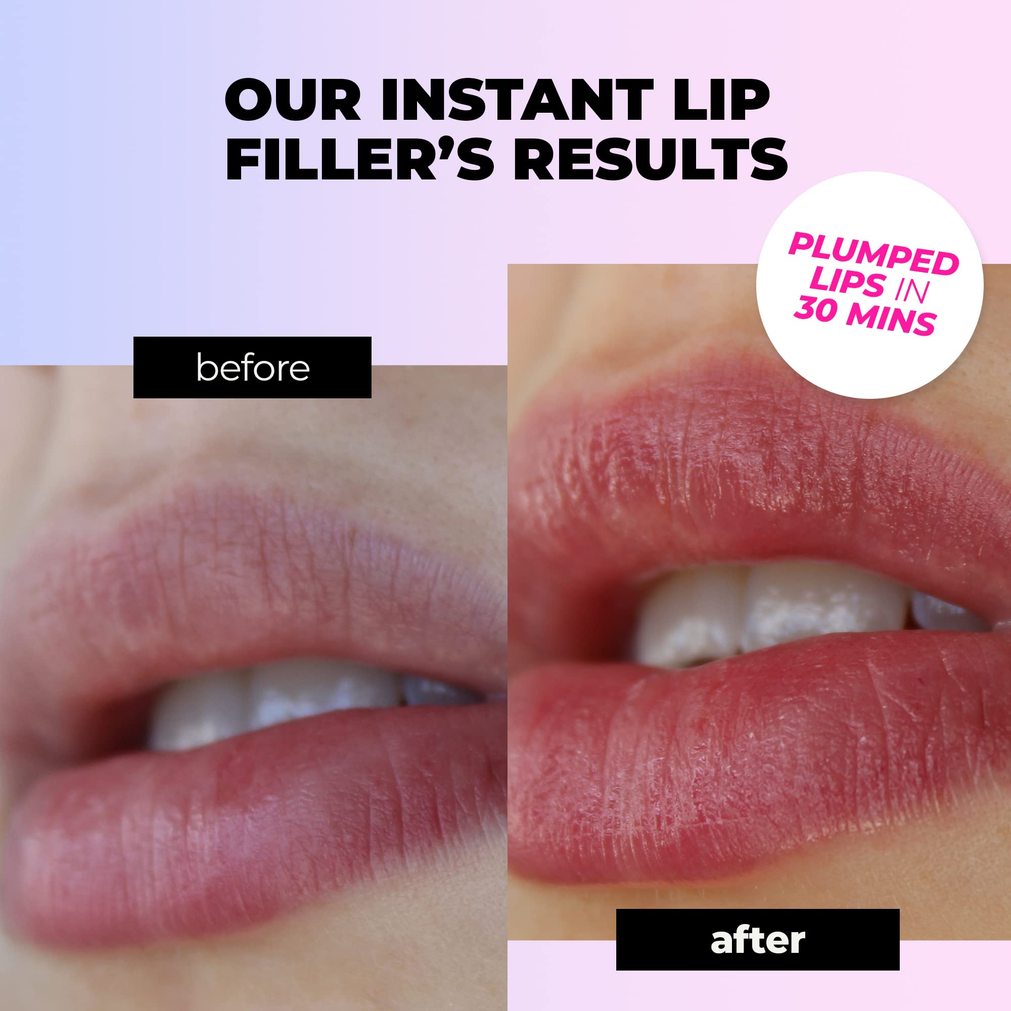 Vitamasques Instant Lip Filler for Plumped Lips in 30 Mins Vegan Collagen, Multi-Molecular Hyaluronic Acid & 400 Dissolving Micro-Dart Technology for Instant & Long-Lasting Results