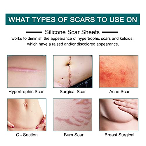 Silicone Scar Sheets (1.6β x 120β Roll-3M), Silicone Scar Tape Roll, Scar Silicone Strips, Reusable, Professional Scar Removal Sheets for C-Section, Surgery, Burn, Keloid, Acne et
