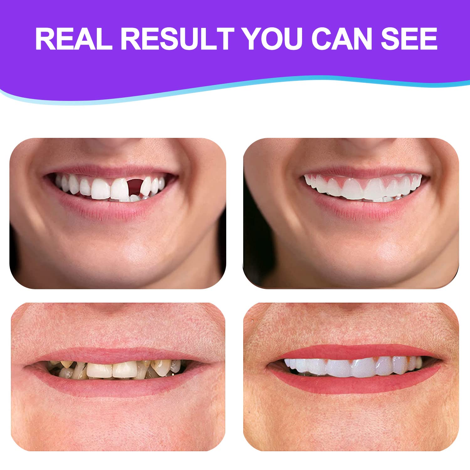 YUANDAN Fake Teeth, 2 PCS Dentures Teeth for Upper and Lower Jaw, Nature and Comfortable, Protect Your Teeth and Regain Confident Smile A1 White