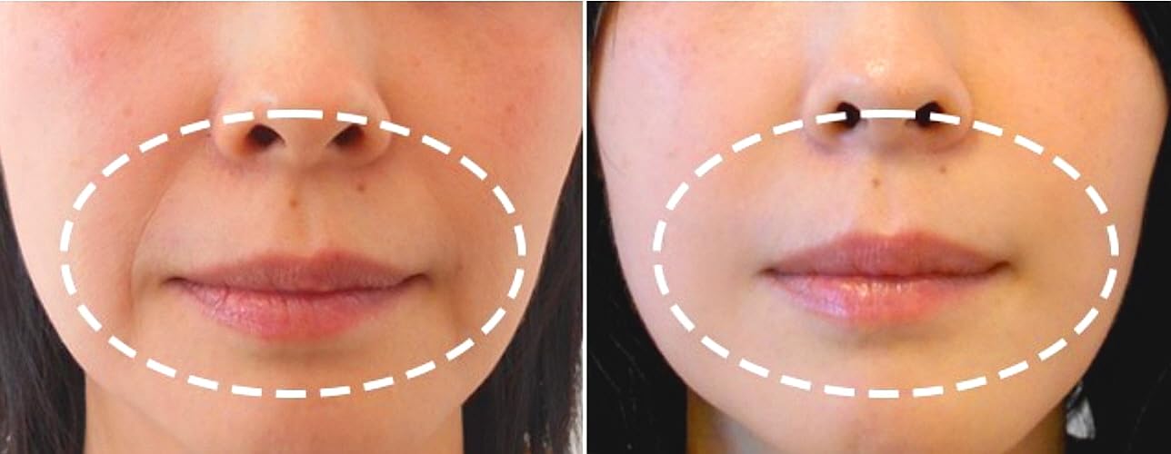 WHITESILK―(𝟐𝟎𝟐𝟒 𝐔𝐩𝐠𝐫𝐚𝐝𝐞𝐝) [(0.03%) Retinaldehyde +(1%) Bakuchiol] INSTANT Wrinkle Smoothing & Line Filler Cream (30ml/1oz)