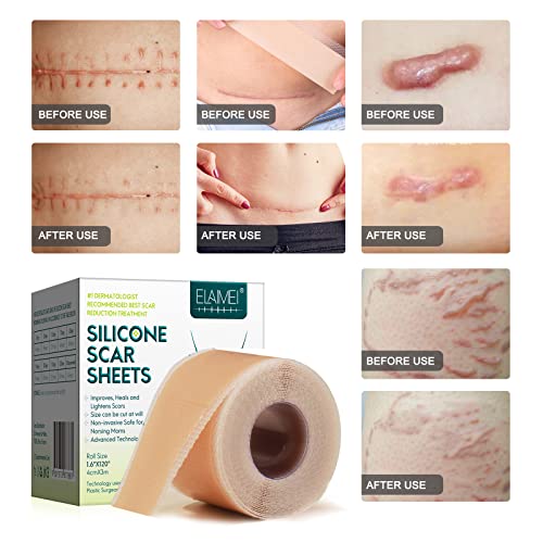 Silicone Scar Sheets (1.6β x 120β Roll-3M), Silicone Scar Tape Roll, Scar Silicone Strips, Reusable, Professional Scar Removal Sheets for C-Section, Surgery, Burn, Keloid, Acne et