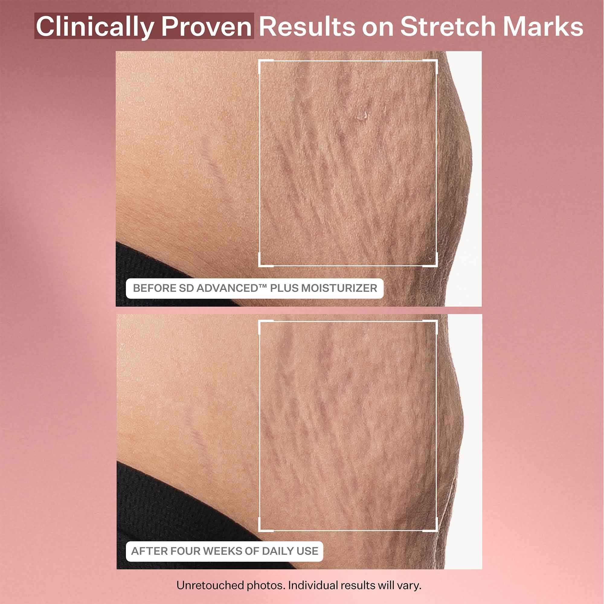 StriVectin Anti-Wrinkle SD Advanced PLUS Intensive Moisturizing Concentrate for Wrinkles and Stretch Marks with Collagen-Targeting Technology, 4 Fl Oz