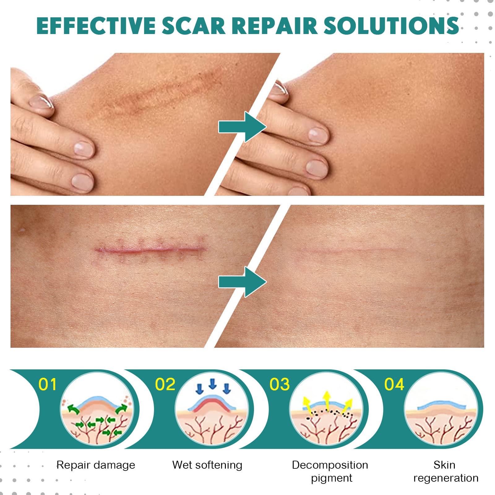 Pumkot Silicone Scar Sheets, Silicone Scar Tape(1.6β x 120β Roll-3M), Scar Removal Away Strips for Surgical Scars, Keloid, C-Section, Burn et