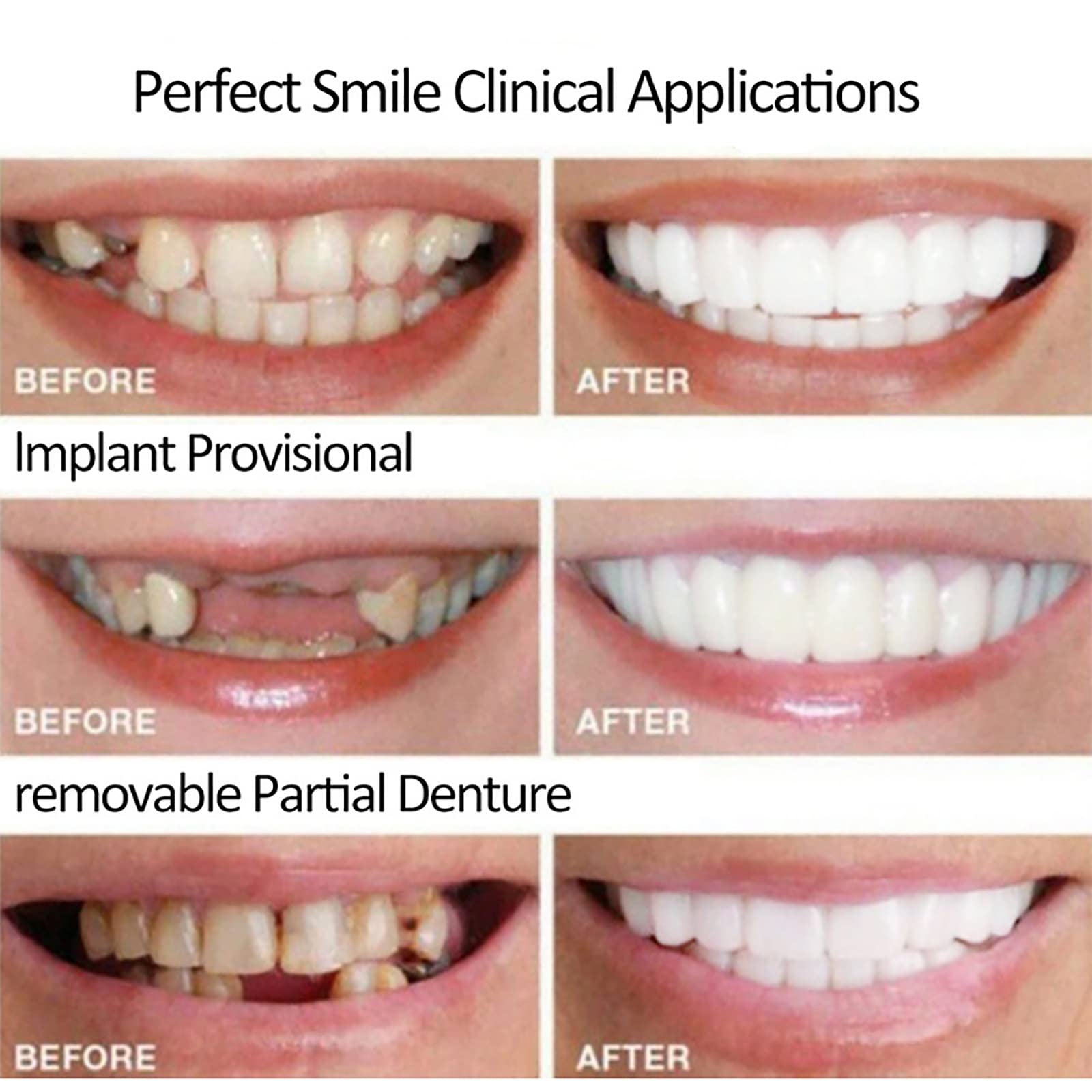 New Upgraded Dentures, Upper and Lower Denture Veneers Natural Shade and Comfort Fit, Women's and Men's Dentures