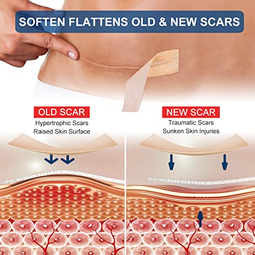 Silicone Scar Sheets (1.6β x 120β Roll-3M), Silicone Scar Tape Roll, Scar Silicone Strips, Reusable, Professional Scar Removal Sheets for C-Section, Surgery, Burn, Keloid, Acne et