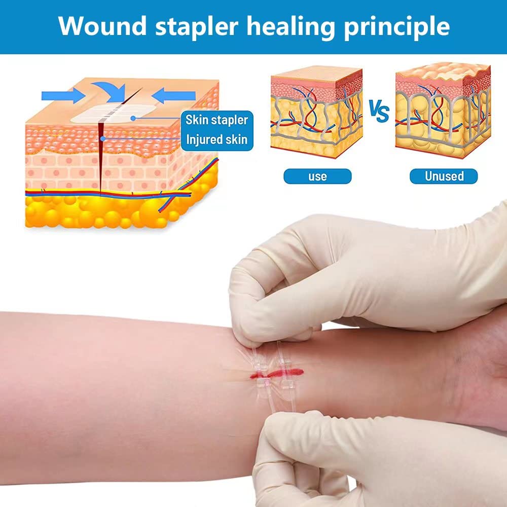 Zip Stitch Wound Closure Kit, Butterfly Bandages, Surgical Quality, Quick Clot for Easy Use, Emergency Laceration Closures, Suture-Free Surgical Repairment, First Aid Wound Care (Yellow, 2)