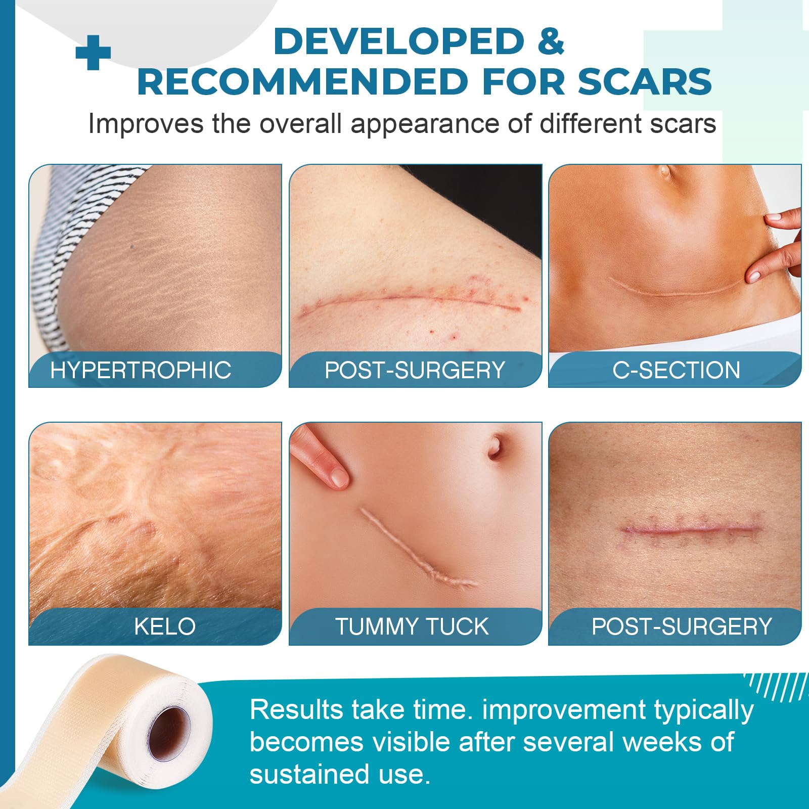 Silicone Scar Sheets, Silicone Scar Tape(1.6βx 60β Roll-1.5M), Silicone Scar Strips, Professional Scar Removal Sheets for Surgical Scars, Keloid, C-Section, Burn et