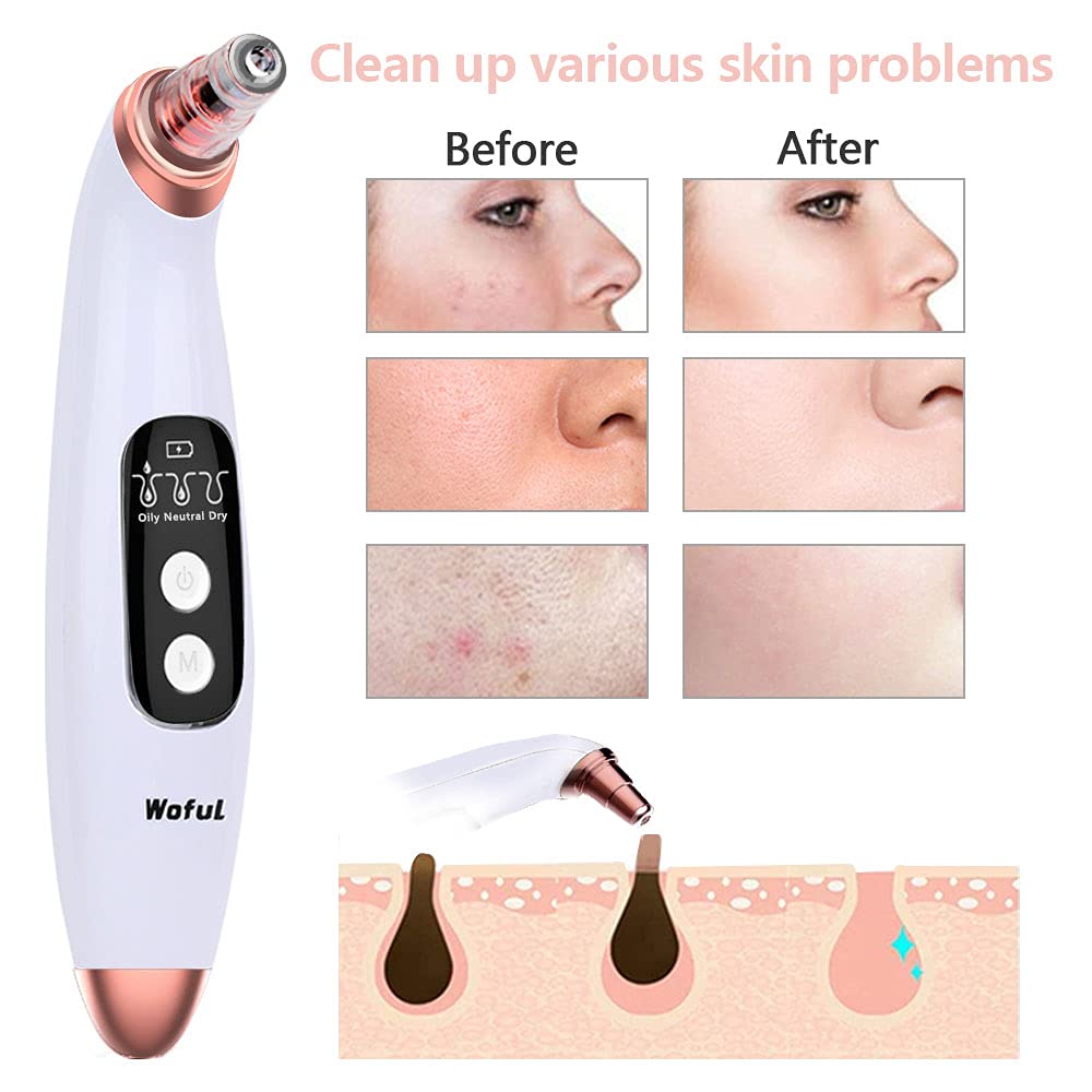 Woful Blackhead Remover Vacuum,Black Head Pore Vacuum with 6 Probes, Microdermabrasion Blackhead Extractor Tool (Blackhead Remover)