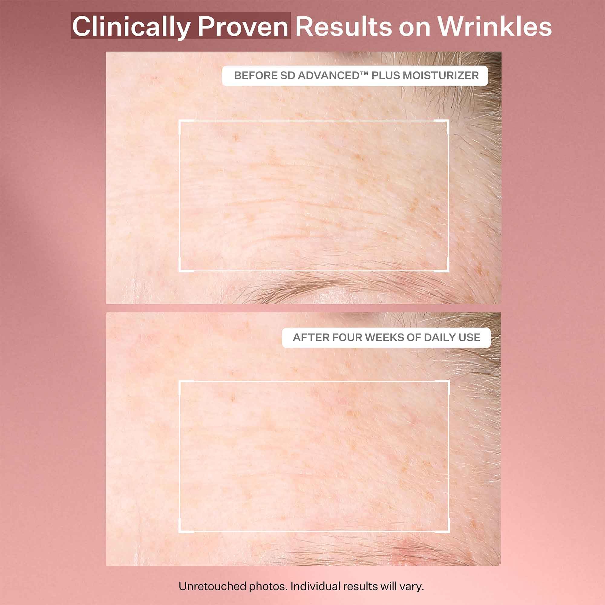 StriVectin Anti-Wrinkle SD Advanced PLUS Intensive Moisturizing Concentrate for Wrinkles and Stretch Marks with Collagen-Targeting Technology, 4 Fl Oz
