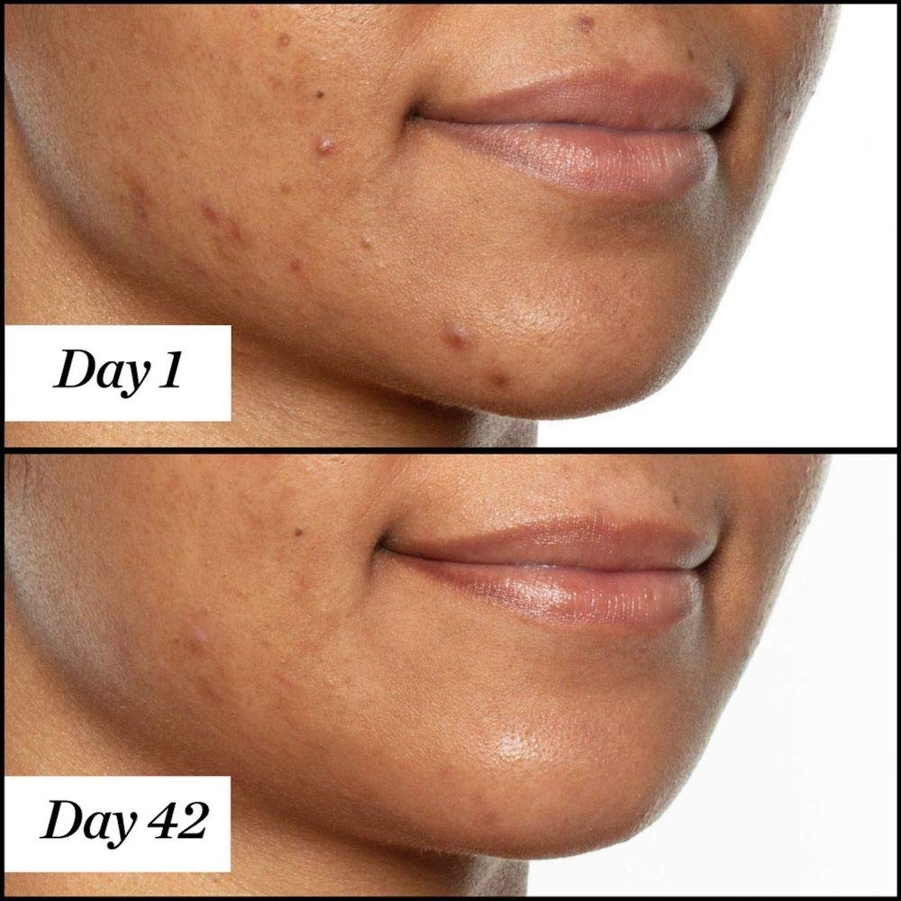 Sunday Riley U.F.O. Ultra-Clarifying Acne Treatment Face Oil 0.5oz