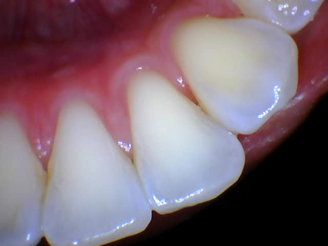 TELICAM Intraoral Camera Dental, Works with Eaglesoft, Dexis, Apeteryx, Carestream, Tigerview