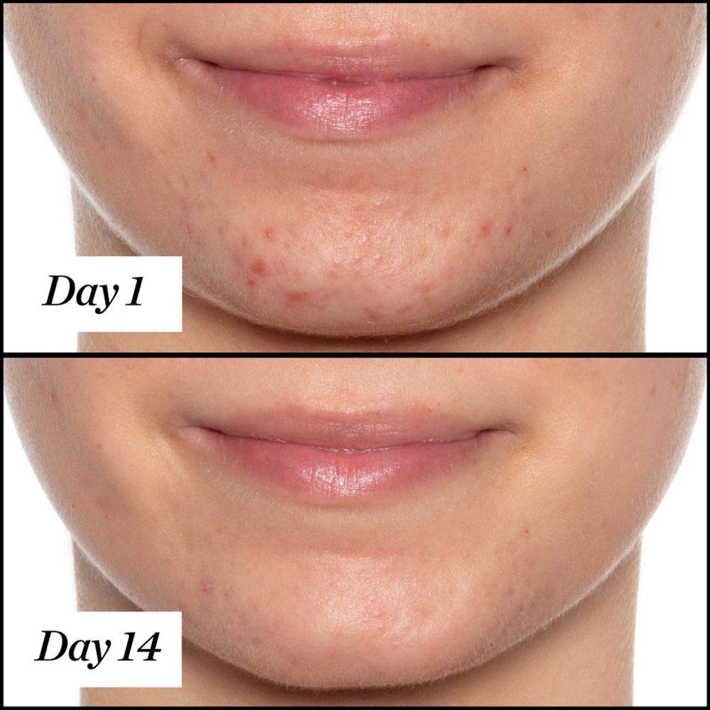 Sunday Riley U.F.O. Ultra-Clarifying Acne Treatment Face Oil 0.5oz