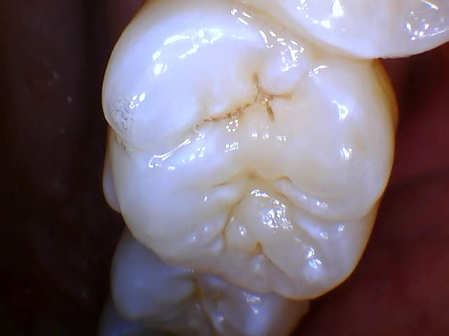 TELICAM Intraoral Camera Dental, Works with Eaglesoft, Dexis, Apeteryx, Carestream, Tigerview